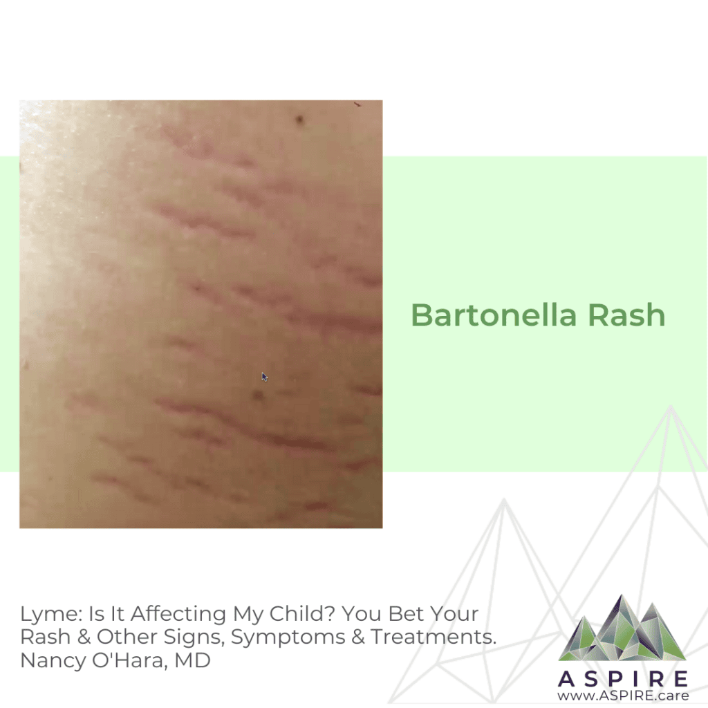 Lyme Co-Infections Overview - Dr. O'Hara - Aspire